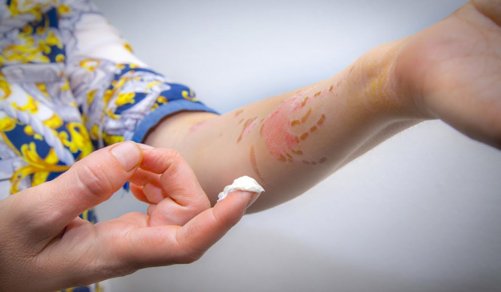 Como curar las quemaduras con remedios caseros - React Spain Magazine